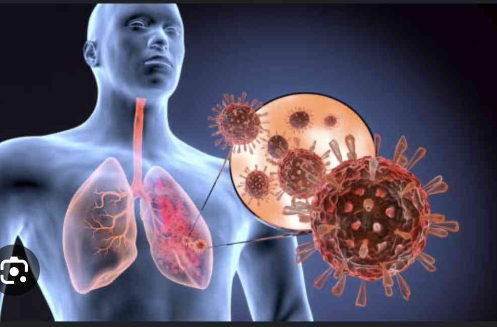 Complications of pneumonia - MirrorLog.com Complications of pneumonia - MirrorLog.com