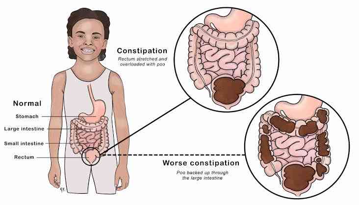 Signs and symptoms of constipation - MirrorLog.com